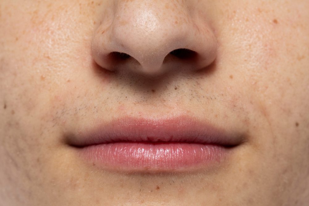 7 Cara Menghilangkan Blackhead di Area Hidung | JAC