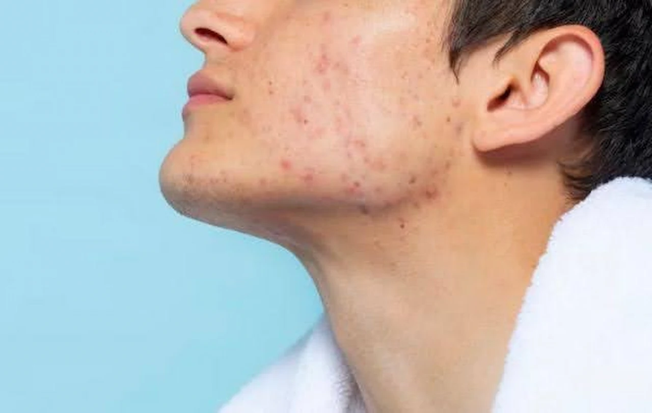 Jerawat di Leher dan Rahang: Penyebab, dan Cara Mengatasinya