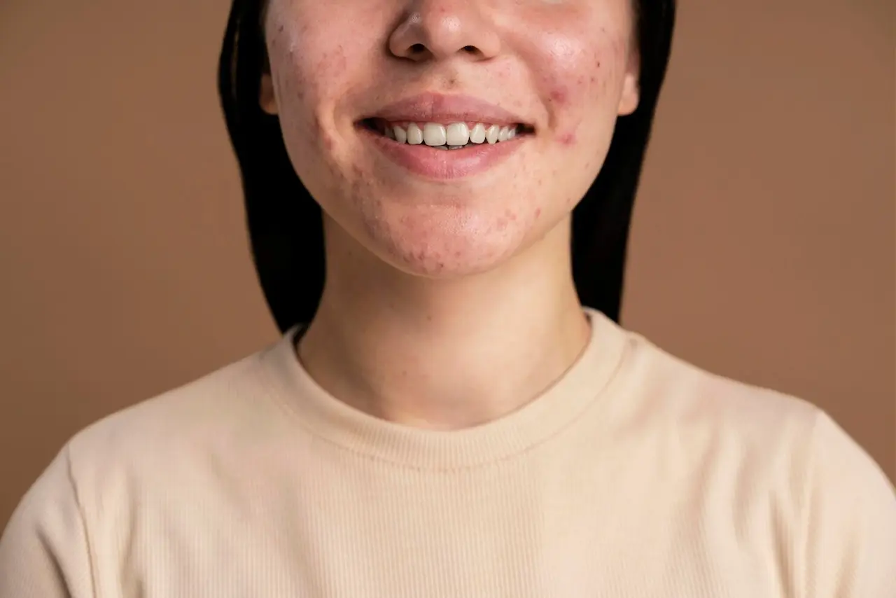 4 Cara Menghilangkan Keloid di Wajah secara Efektif