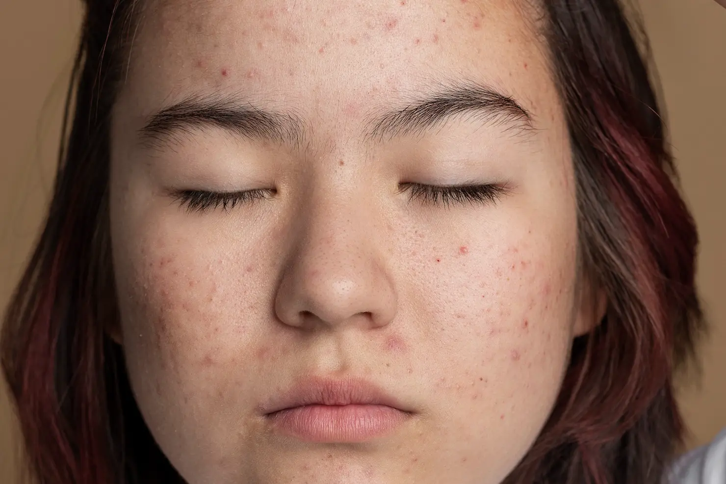 6 Perawatan Muka Berminyak dan Berjerawat yang Efektif