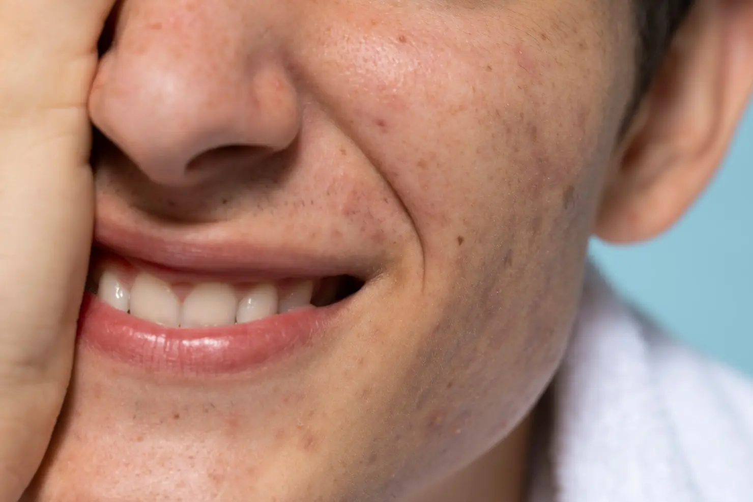 7 Penyebab Banyak Komedo di Muka dan Cara Mencegahnya