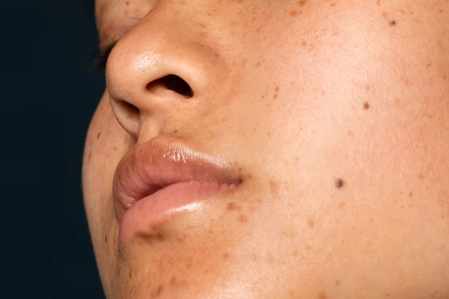 5 Ciri-ciri Flek Hitam, Penyebab, dan Cara Mengatasinya | JAC