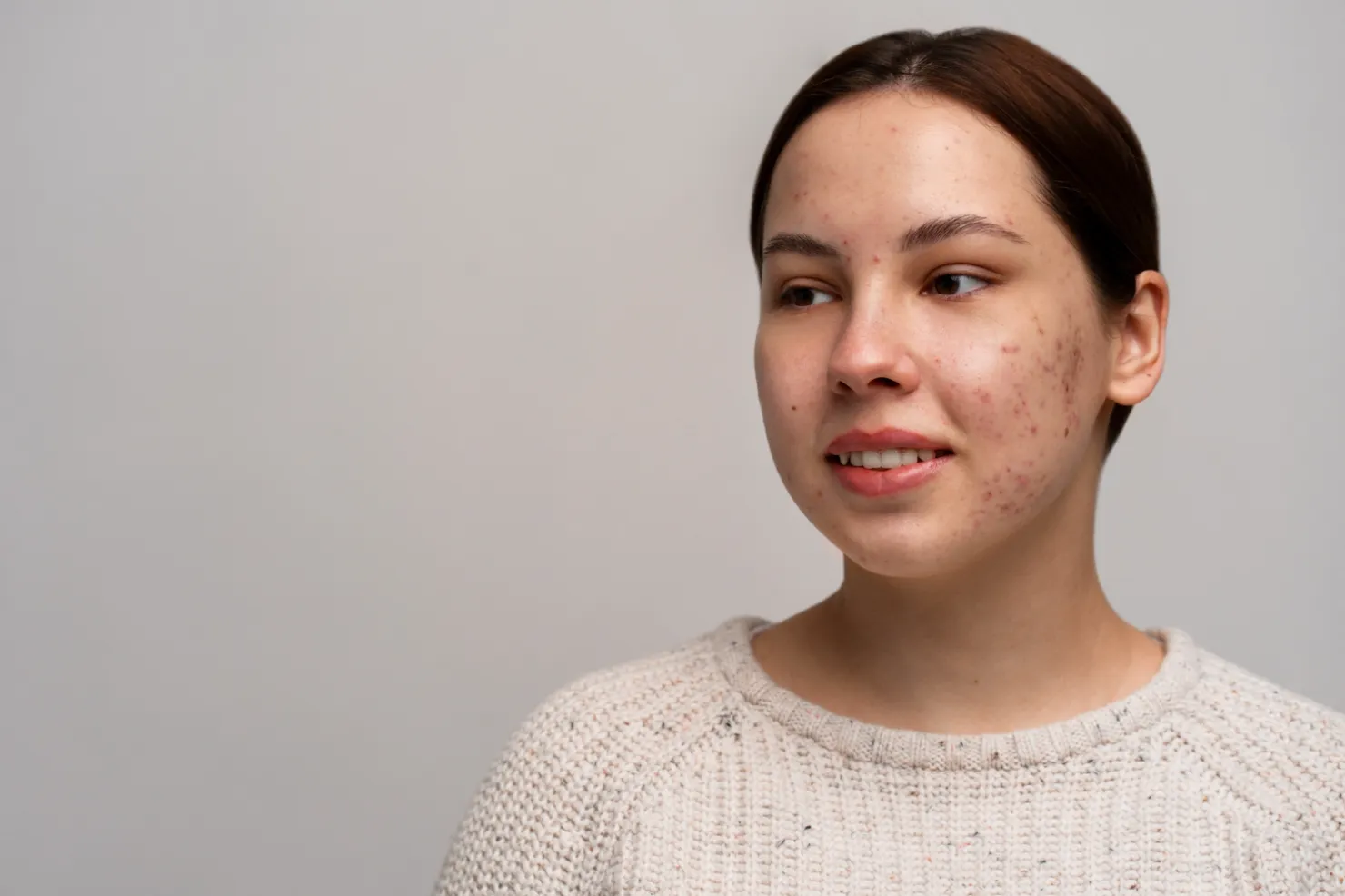 5 Penyebab Jerawat Papula di Pipi dan Cara Mengatasinya | JAC